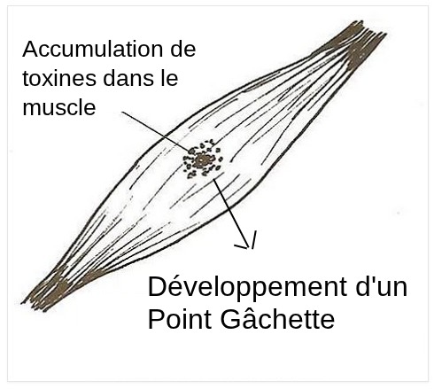 Identifier les Points Gâchettes (Trigger Points) | Guy Bouchard, ND